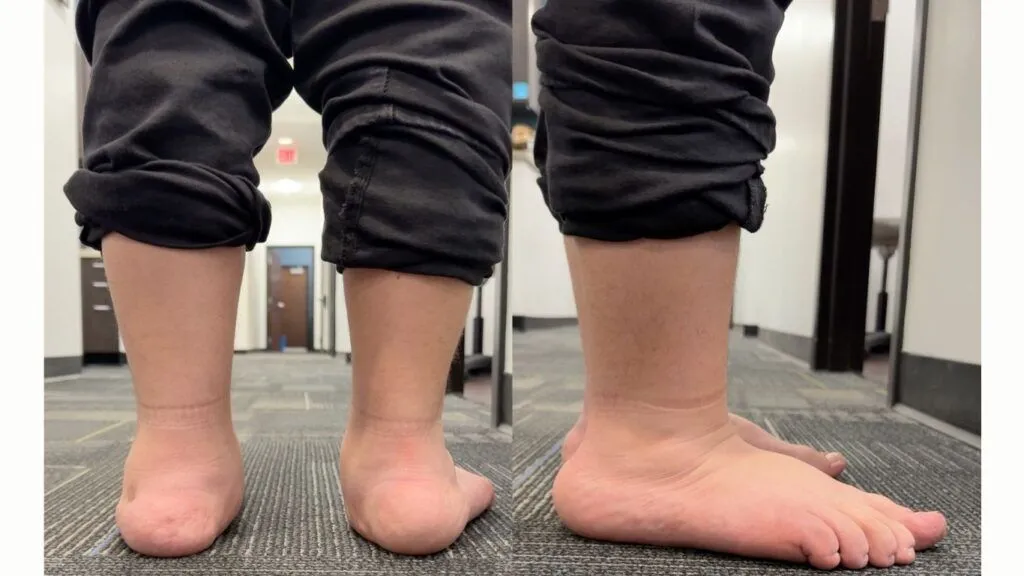 Pediatric Flat Feet - What Every Parent Should Know