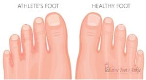 Children's Athletes Foot Signs Symptoms Causes and Treatment