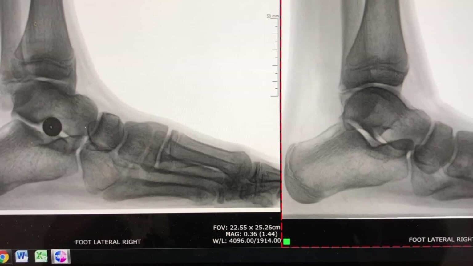 Hyprocure - Pediatric Foot & Ankle