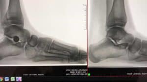 Hyprocure - Pediatric Foot & Ankle