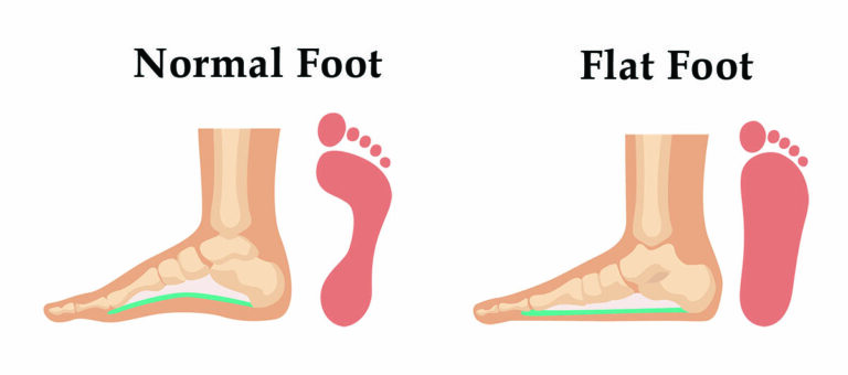 Does My Child Have Flat Feet? And What To Do About It - Pediatric Foot ...