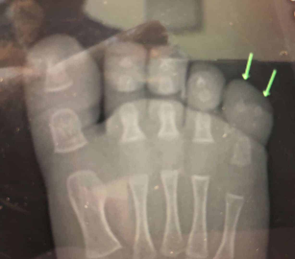 Pediatric Polydactyly (Extra Toe on Foot) Causes & Treatment