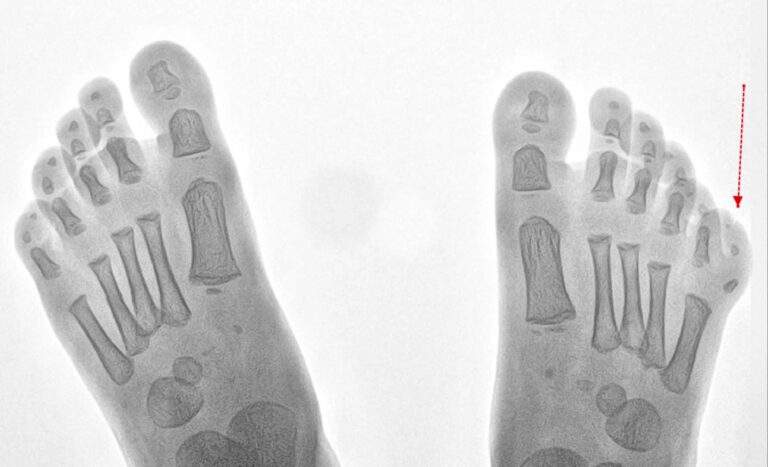 Pediatric Polydactyly (Extra Toe on Foot) Causes & Treatment