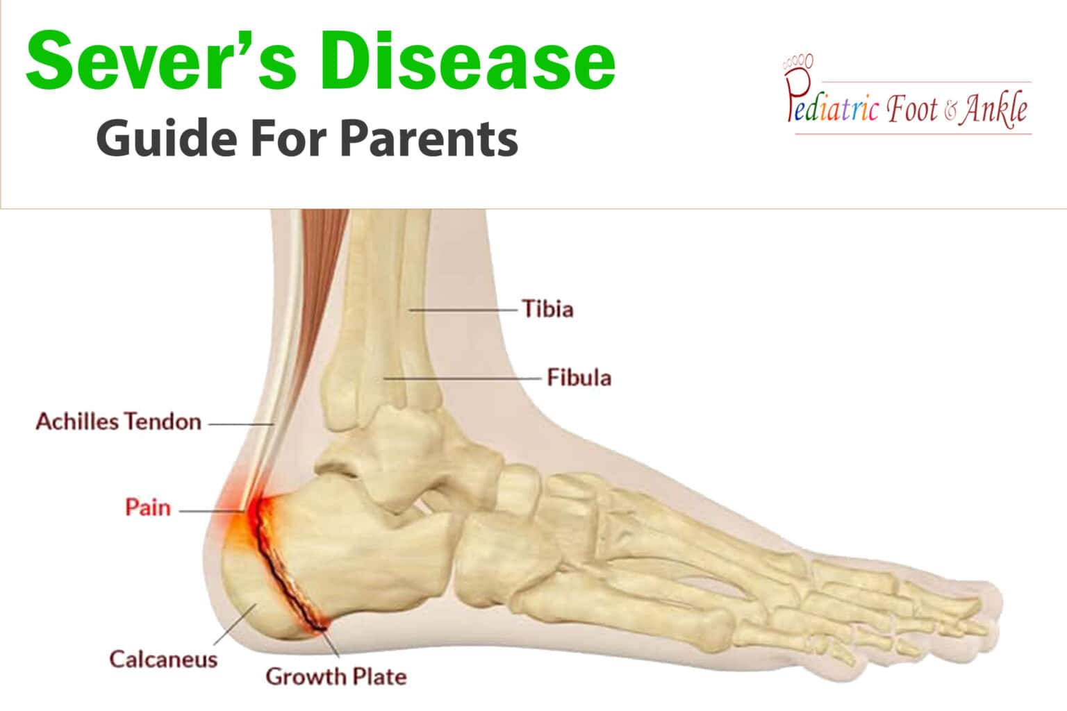 Sever's Disease: A Guide for Parents - Pediatric Foot & Ankle