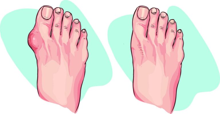 What's the Difference Between Lapiplasty and Regular Bunion Surgery for ...