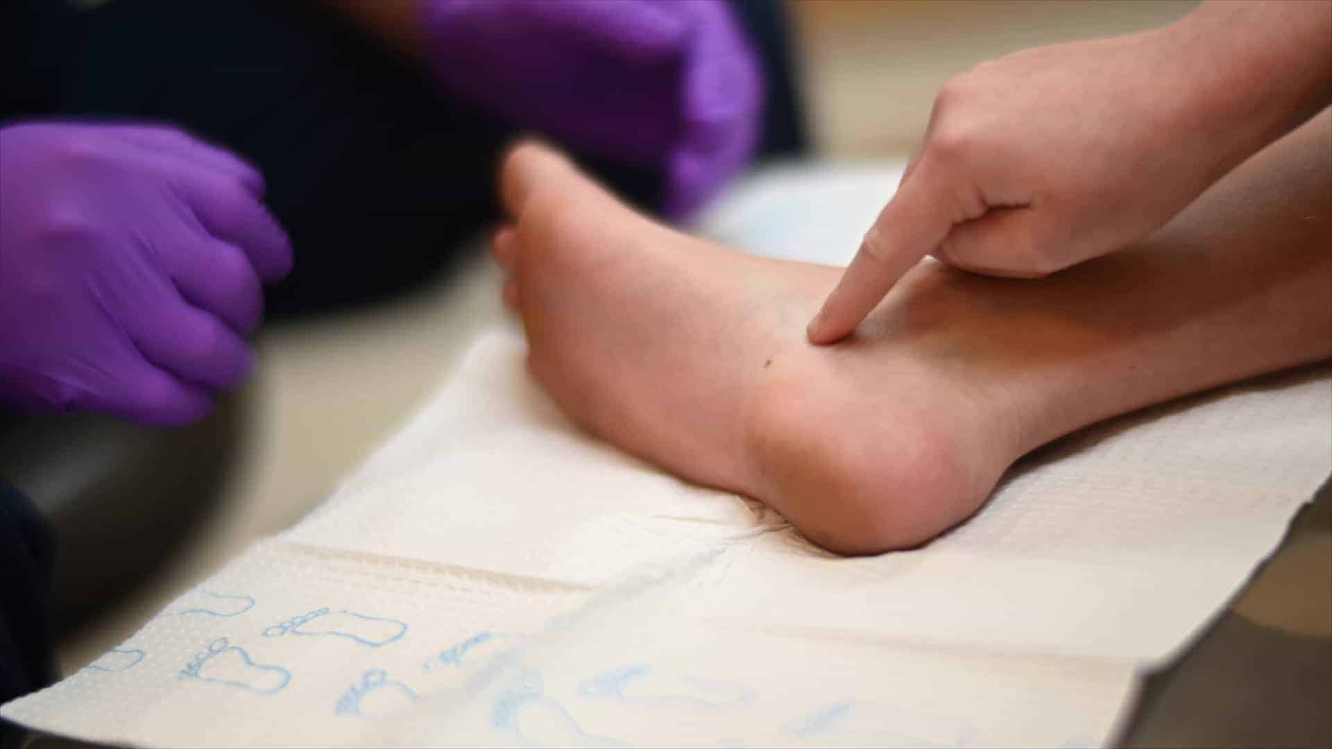 Tarsal Coalitions - Pediatric Foot & Ankle
