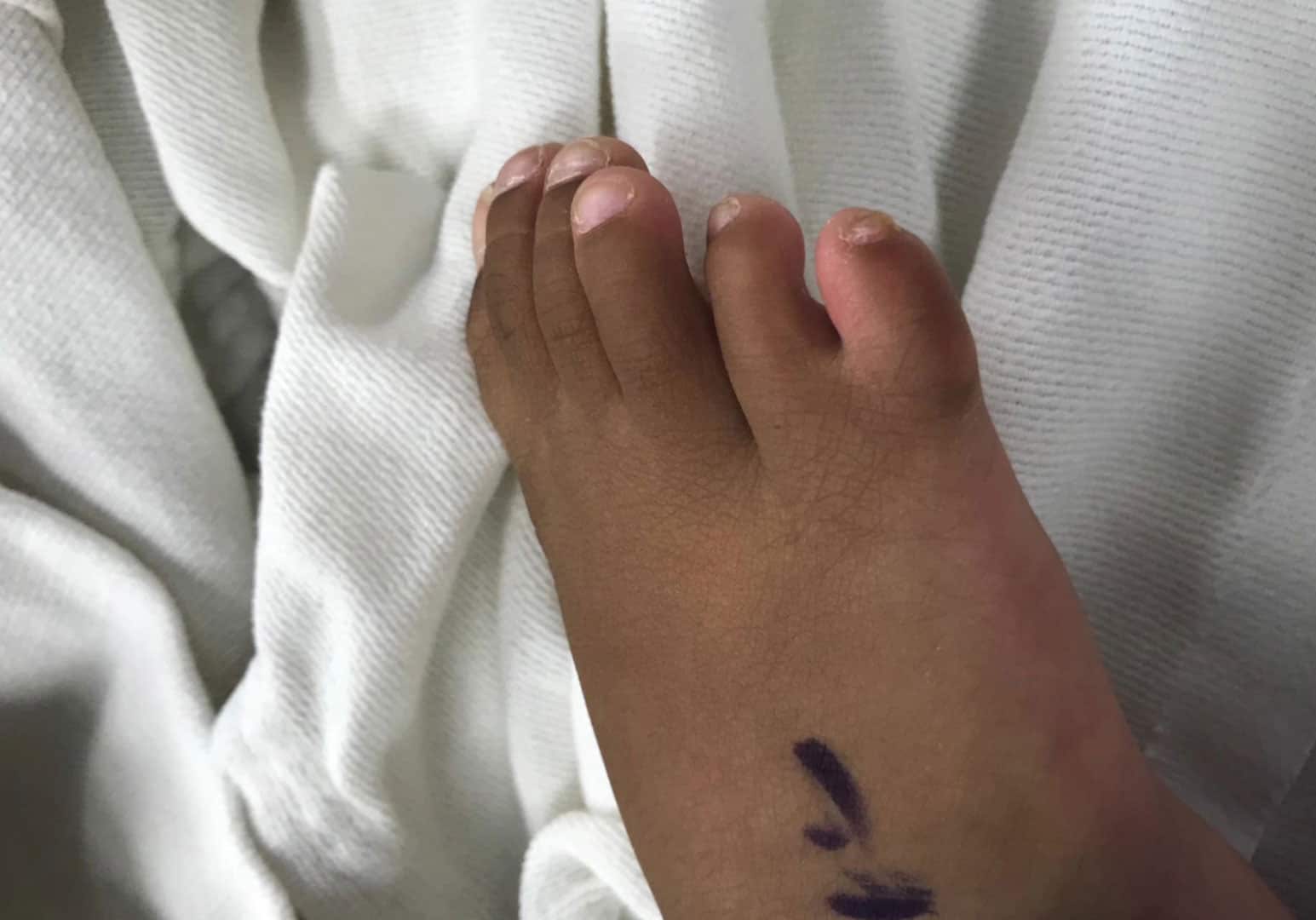Pediatric Polydactyly (Extra Toe on Foot) Causes & Treatment