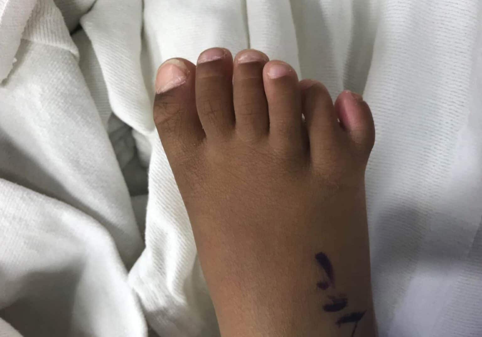 Pediatric Polydactyly (Extra Toe on Foot) Causes & Treatment