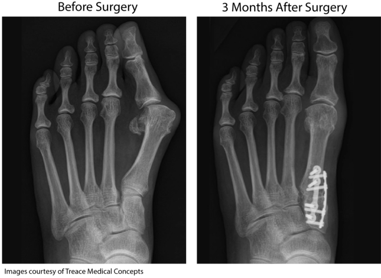 Lapiplasty 3D Bunion Correction for your teen or young adult