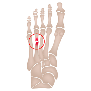 Pediatric Foot Surgeries with OSSIOfiber® Technology