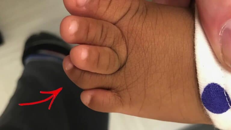 Hammer Toes In Children