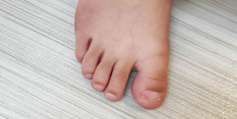 Polydactyly - Pediatric Foot & Ankle