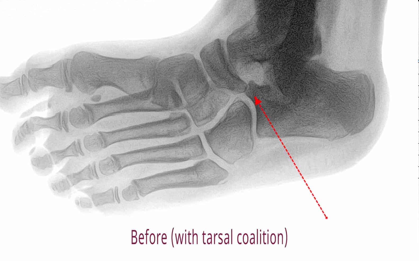Tarsal Coalitions - Pediatric Foot & Ankle